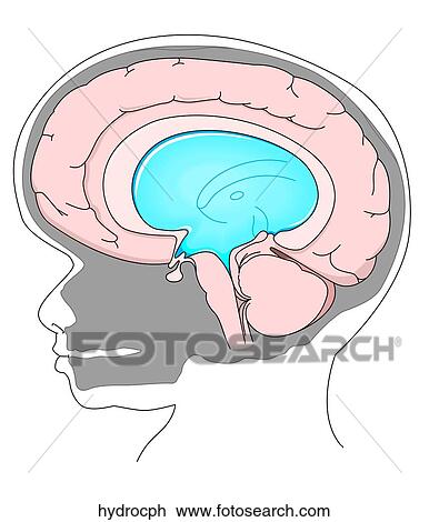 Hydrocephalus Drawing | hydrocph | Fotosearch