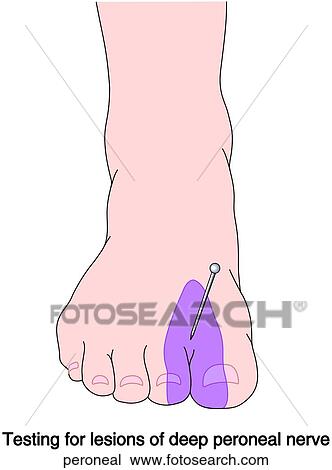 Testing for Lesions of Deep Peroneal Drawing | peroneal | Fotosearch