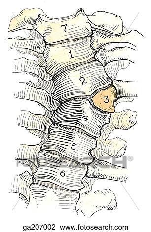Clip Art of Anterior view of a hemivertebra, showing absence of half of ...