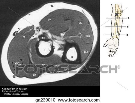 Stock Illustrations of Transverse MRI of forearm: CV, cephalic v.; BR ...