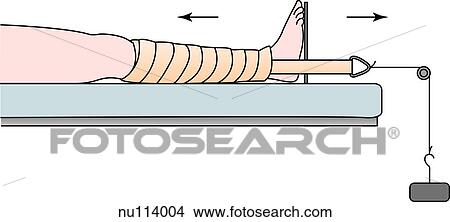 Drawings of Principle of Buck's extension type of traction. The ...
