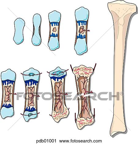 Clipart of Schematic showing stages of bone development. pdb01001 ...