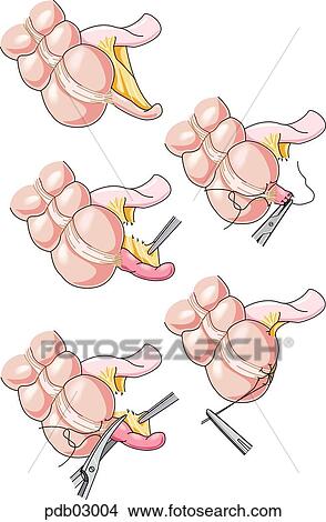 Drawings of Schematic showing steps in appendectomy procedure. pdb03004 ...