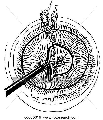 Cervical conization, LLETZ technique Stock Illustration | cog05019 ...