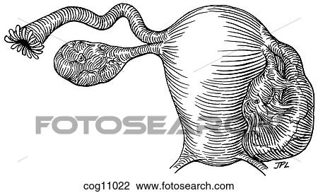 Hydrosalpinx, fallopian Drawing | cog11022 | Fotosearch