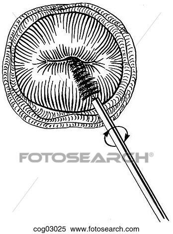 Pap smear Stock Illustration | cog03025 | Fotosearch