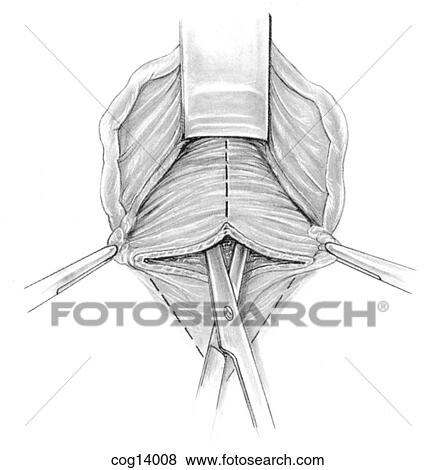 Rectocele repair, part 2 Stock Illustration | cog14008 | Fotosearch