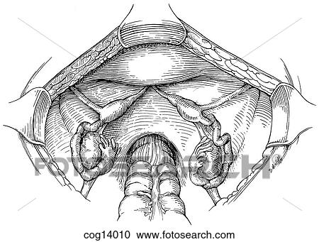 Rokitansky syndrome Stock Illustrations cog14010