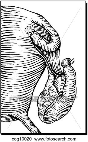 Sterilization, Irving technique Clipart | cog10020 | Fotosearch