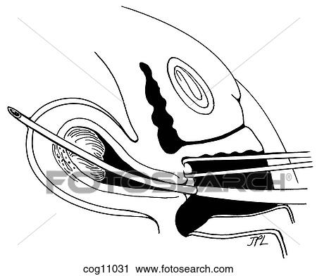 Uterine fundal perforation with suction curette Clip Art | cog11031 ...