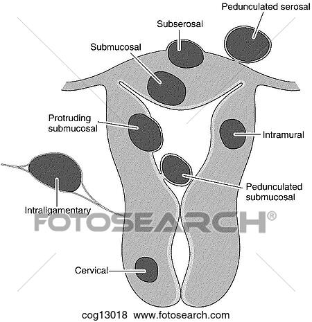 Uterine myomas Stock Illustration | cog13018 | Fotosearch