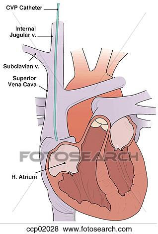Catheters, CVP Stock Illustration | ccp02028 | Fotosearch
