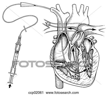 Thermodilution cardiac output measurement Clip Art | ccp02061 | Fotosearch