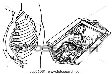 Thoracotomy, left posterolateral Clip Art | ccp05061 | Fotosearch