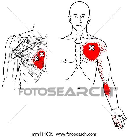 Stock Illustration of Pectoralis major m., trigger points mm111005 ...
