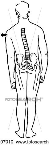 Trunk, lateral shift Clipart | mm207010 | Fotosearch